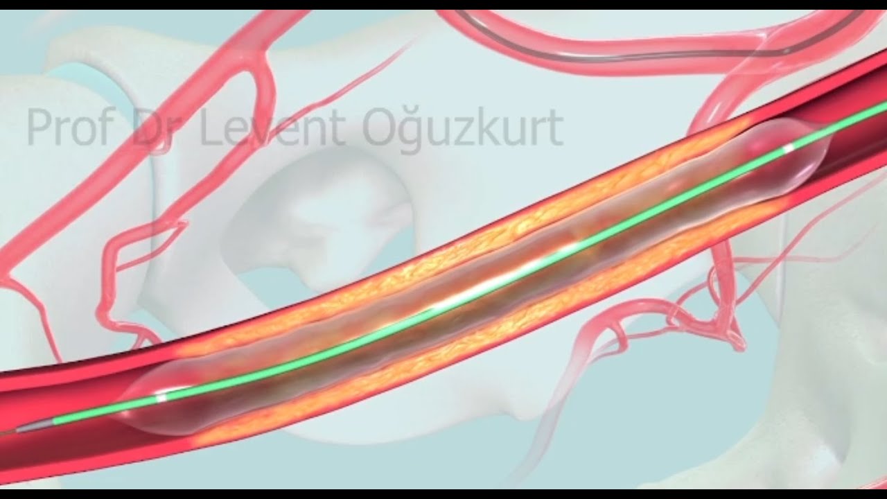Anjiyo yöntemiyle balon ve stent kullanarak tıkalı damarı açmak - YouTube