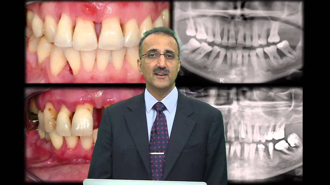 215-00 Restoration of 'Failing Teeth' with Implants in the Aesthetic ...