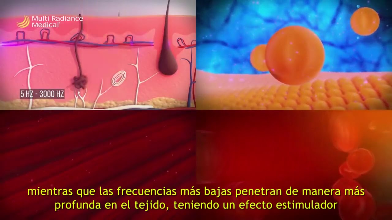 Qué es la Terapia de Láser Súper Pulsado y cómo trabaja. - YouTube