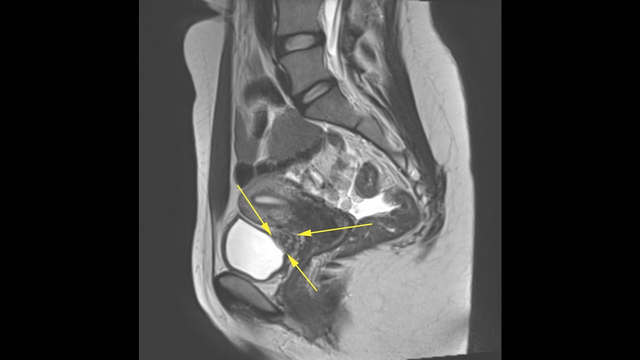 Combined cystoscopic and robotic excision of trigonal bladder nodules ...