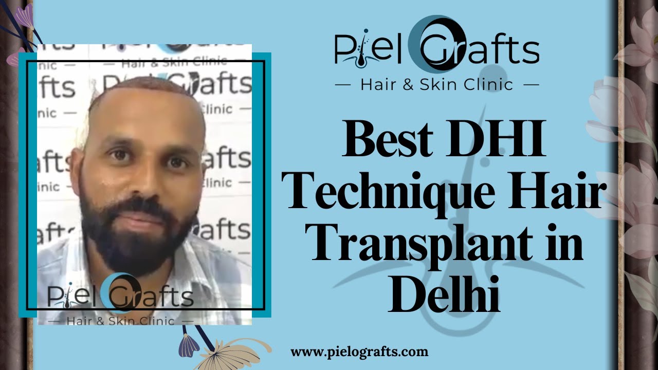 DHI Technique Hair Transplant Review Painless Hair Restoration & Natural Results - YouTube