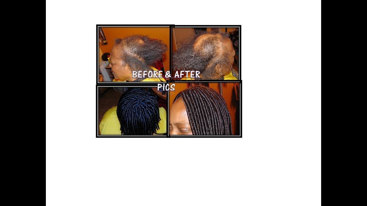 Alopecia Dread Locks Crochets On Damaged/Balding Hair - YouTube