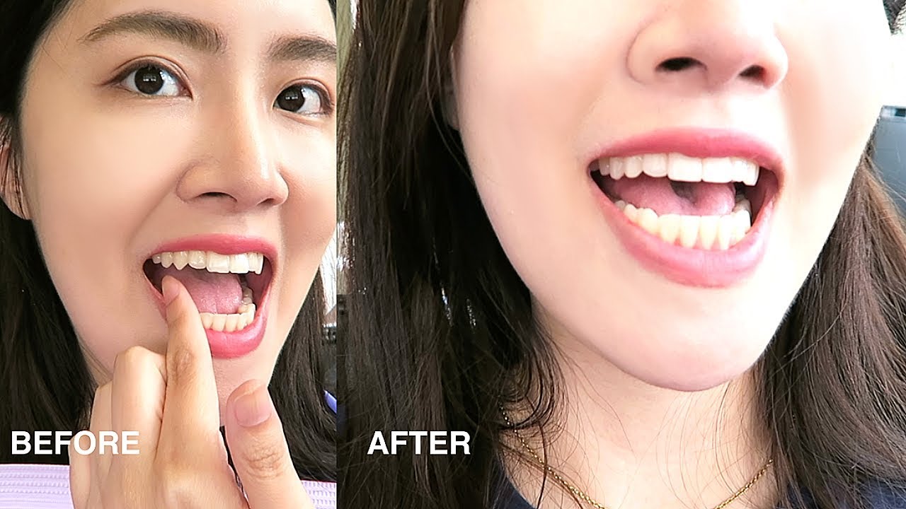 MY INVISALIGN CANINE TEETH SURGERY W BEFORE AFTER RESULTS YouTube