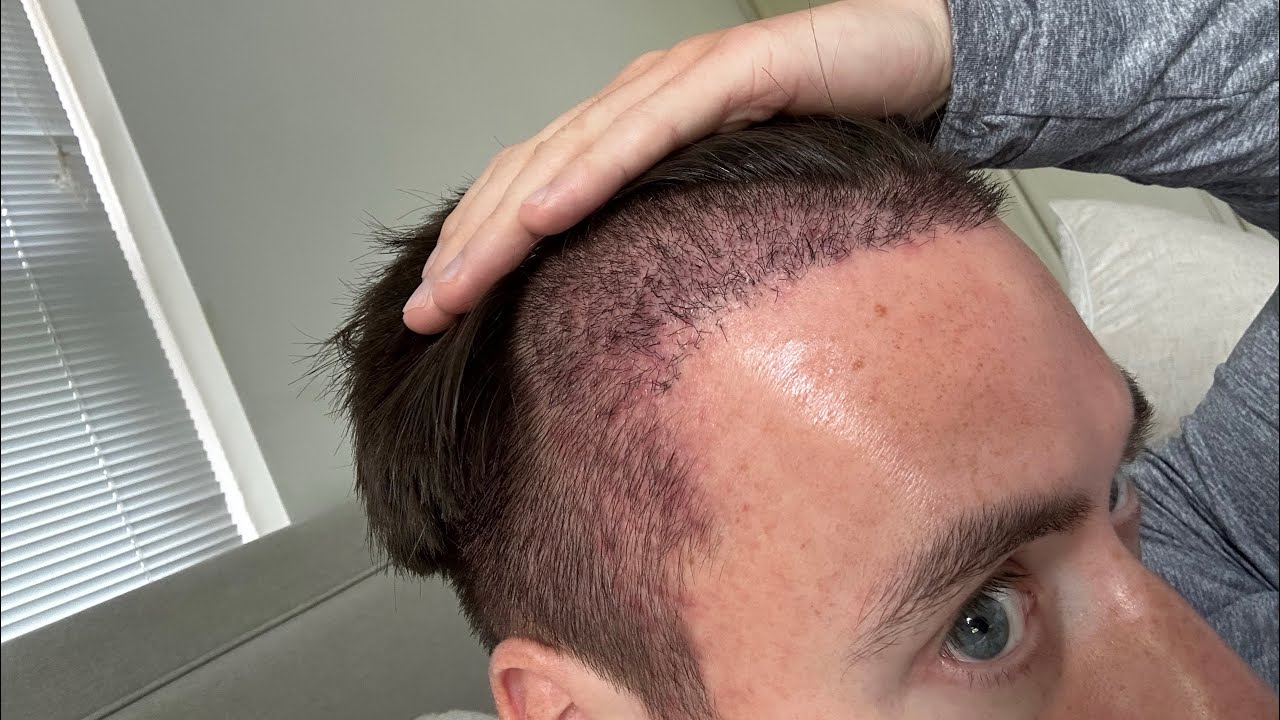 Month 2 Update Post Hair Transplant Istanbul Turkey Cosmedica Youtube