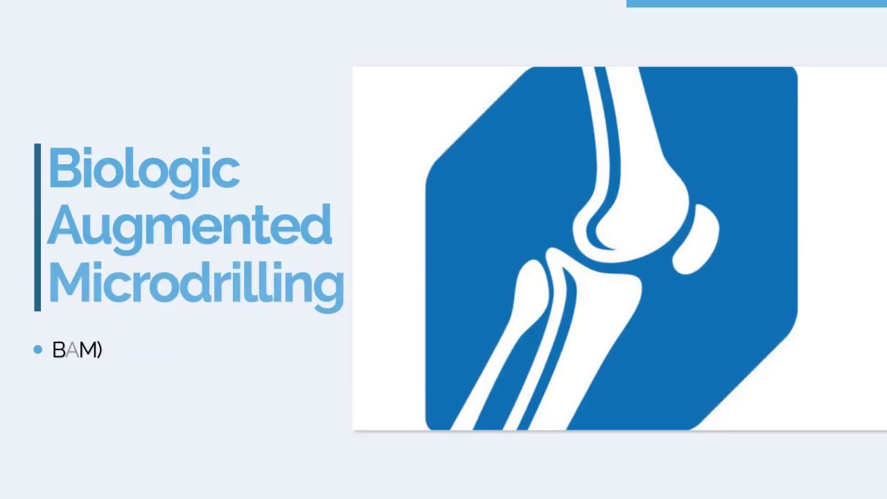 BAM Procedure at Cartilage Regeneration Center - YouTube