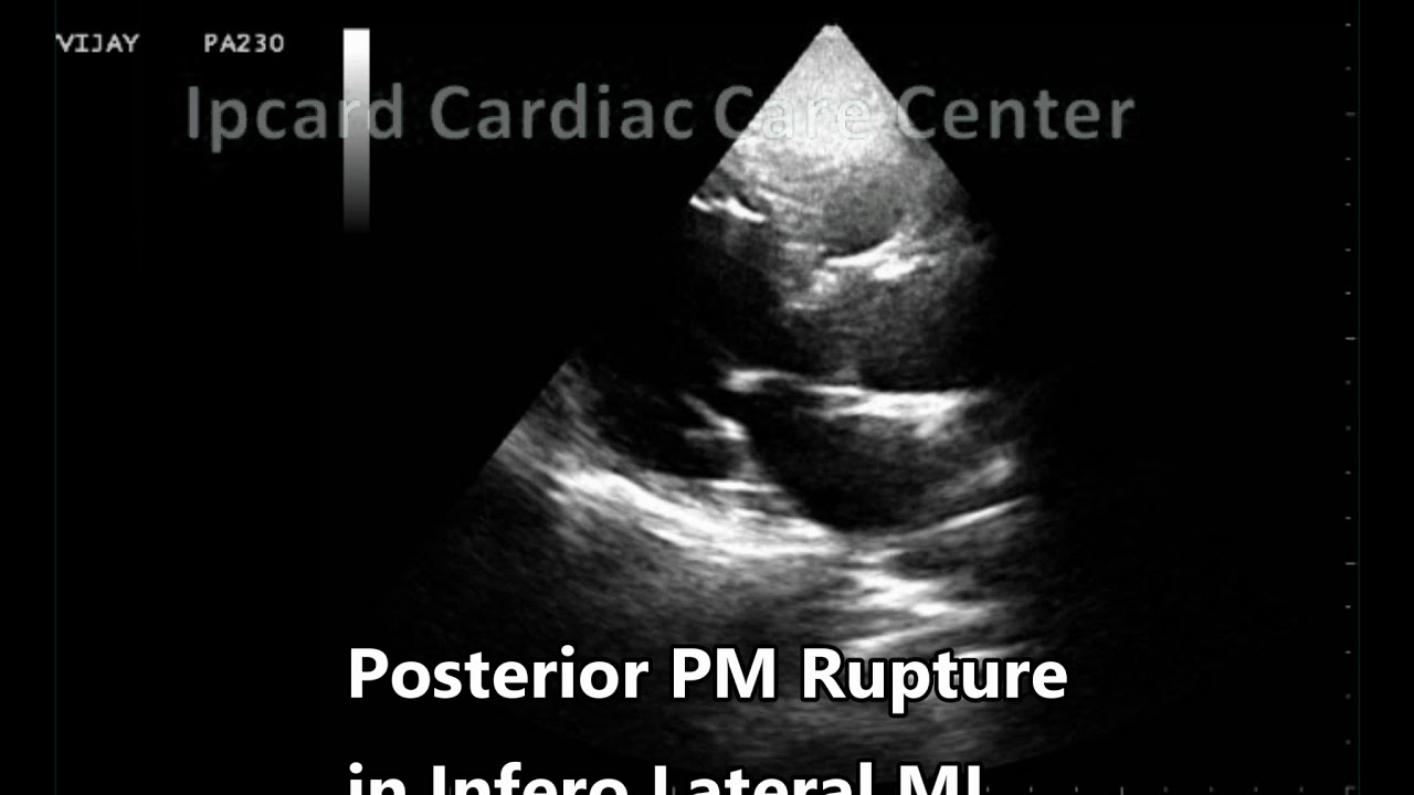 Echo- Papillary Muscle Rupture in Infero Lateral Myocardia - YouTube