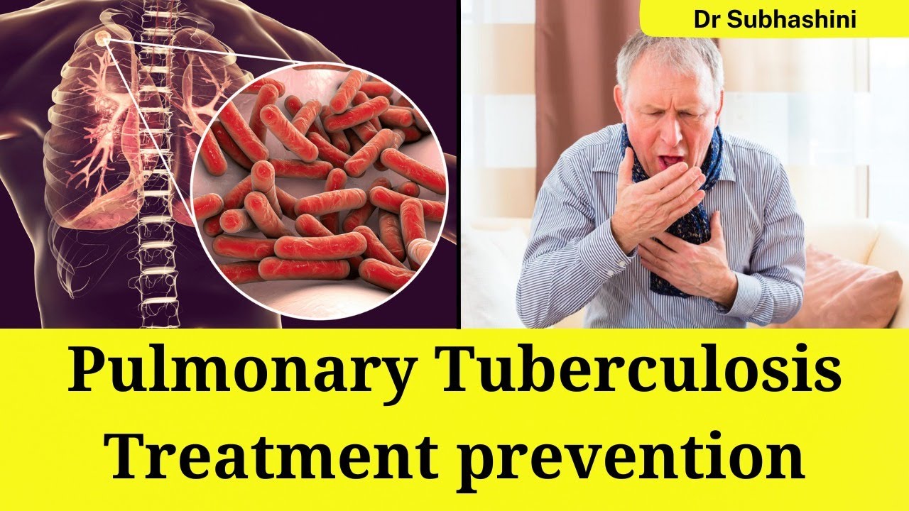 Pulmonary Tuberculosis: Symptoms, Diagnosis, Treatment, Prevention ...
