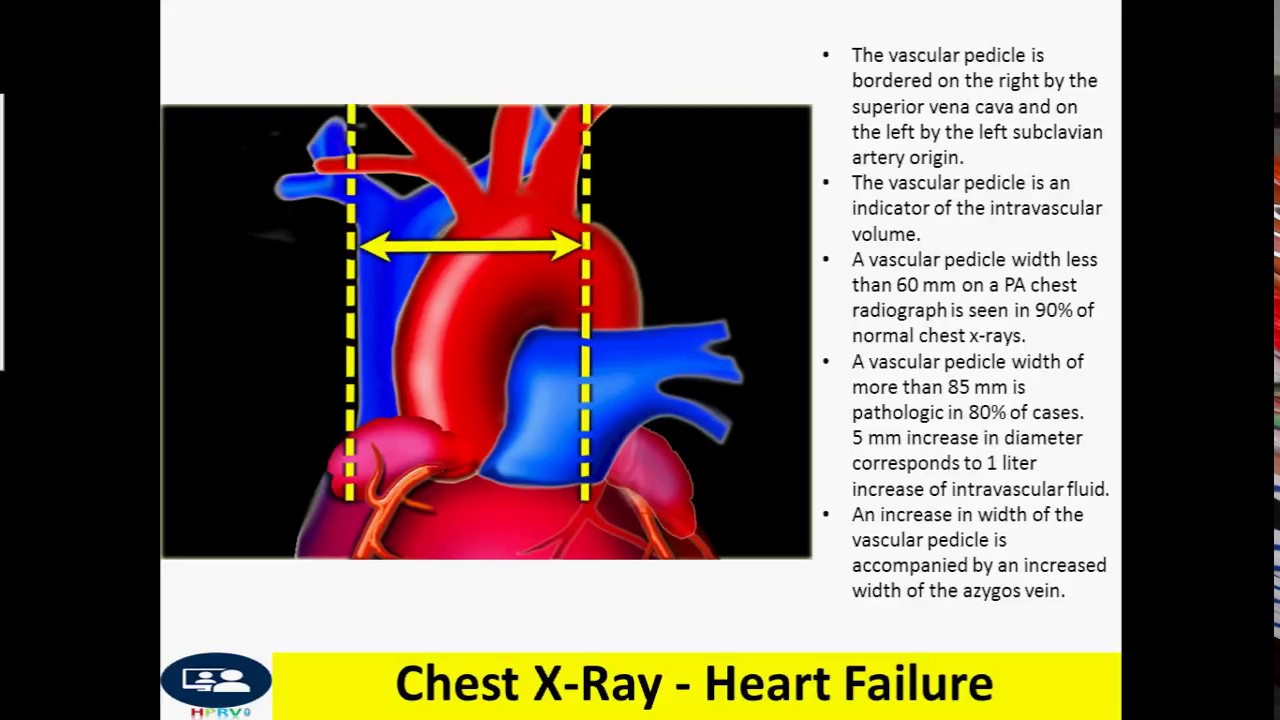 Heart failure X ray - YouTube