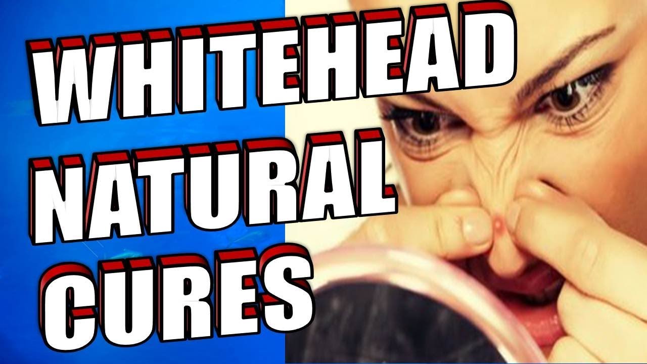 How To Get Rid Of WHITEHEADS From The NOSE FACE CHIN At Home how-to-get-rid-of-whiteheads-from-the-nose-face-chin-at-home