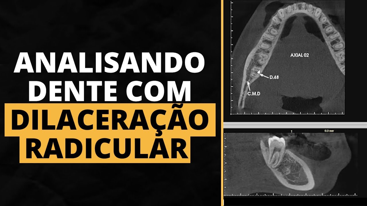 Dilaceração Radicular é Grave - RETOEDU