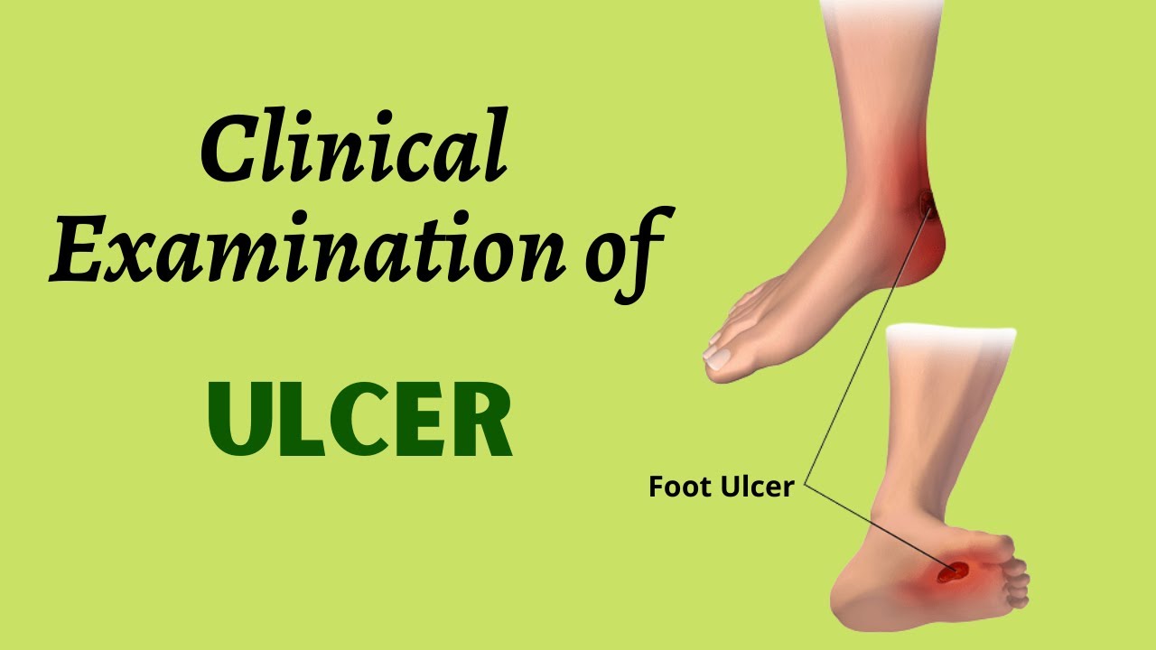 Clinical Examination of an Ulcer | Surgery Video | MedVids Planet - YouTube