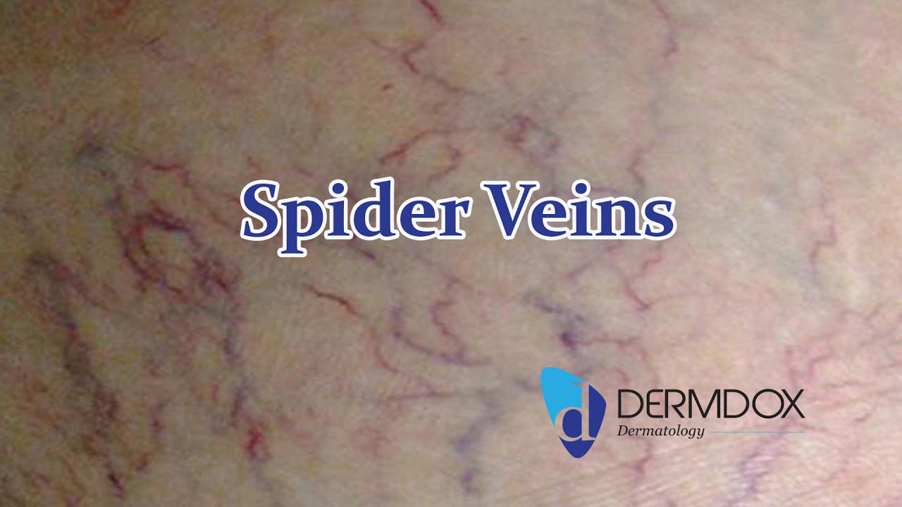 Spider veins - DermDox Dermatology Centers - YouTube