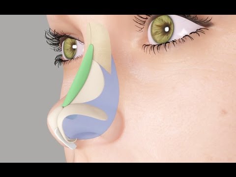 Saddle Nose or Ski Slope Nose Rhinoplasty Nosejob