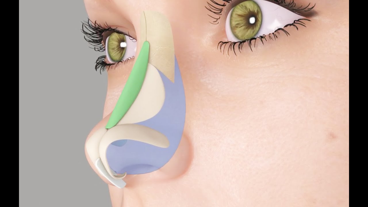 Saddle Nose Or Ski Slope Nose Rhinoplasty Nosejob YouTube saddle-nose-or-ski-slope-nose-rhinoplasty-nosejob-youtube