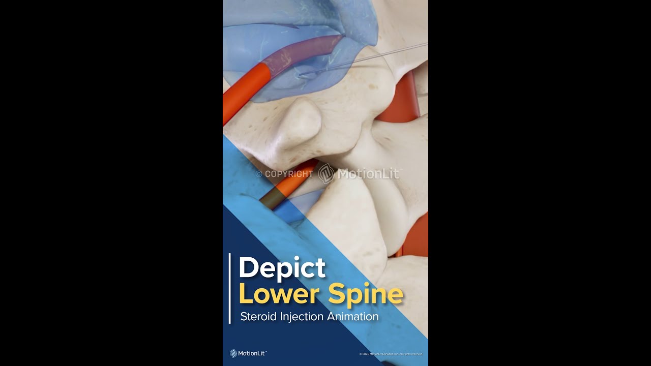 Lumbar Trauma Shown in Compelling Medical Animation - YouTube