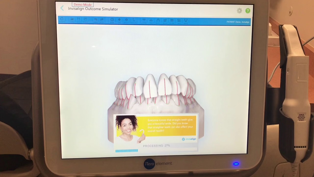 iTero Digital Scan Demo - YouTube