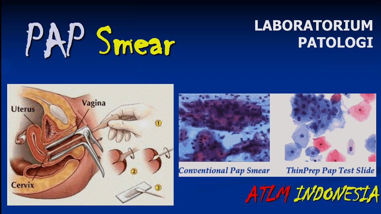 Tes PAP Smear Sitologi | Analis Kesehatan Teknologi Laboratorium Medik ...