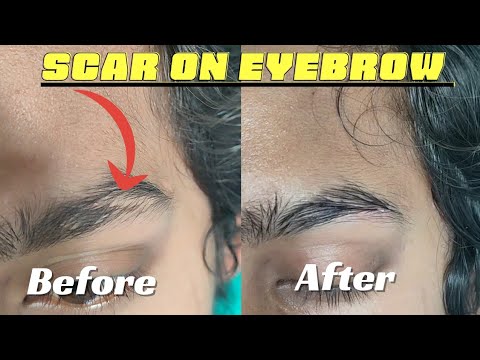Scar on Eyebrow and forehead - Change after scar revision surgery| Scar ...