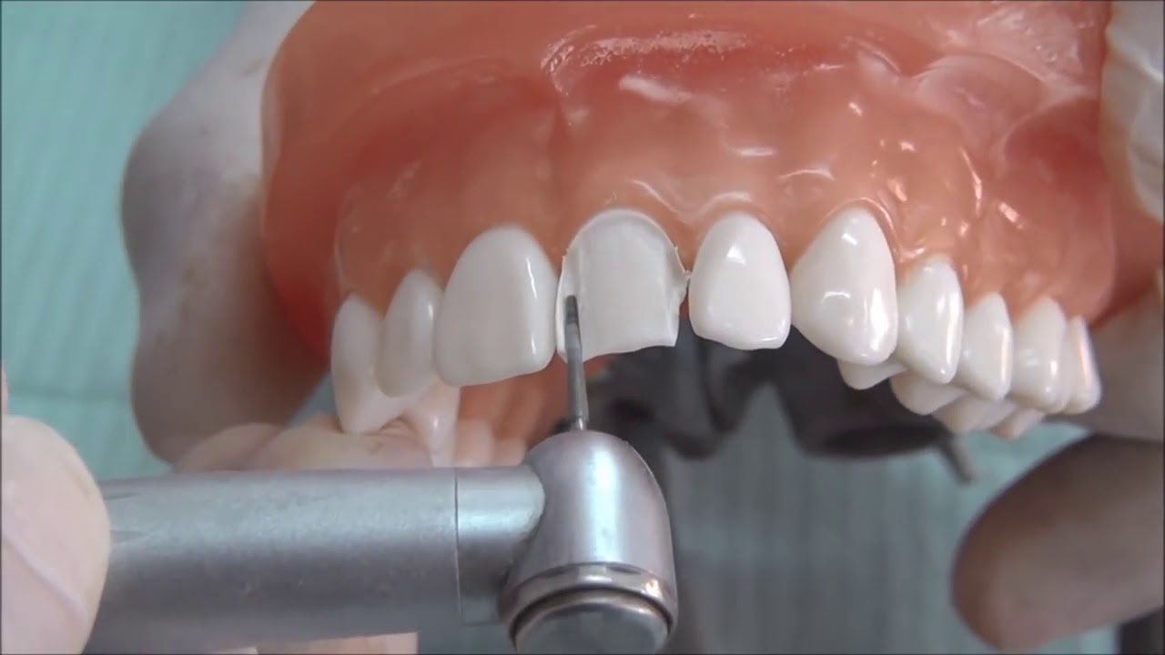 ANTERIOR TOOTH PREPARATION - YouTube