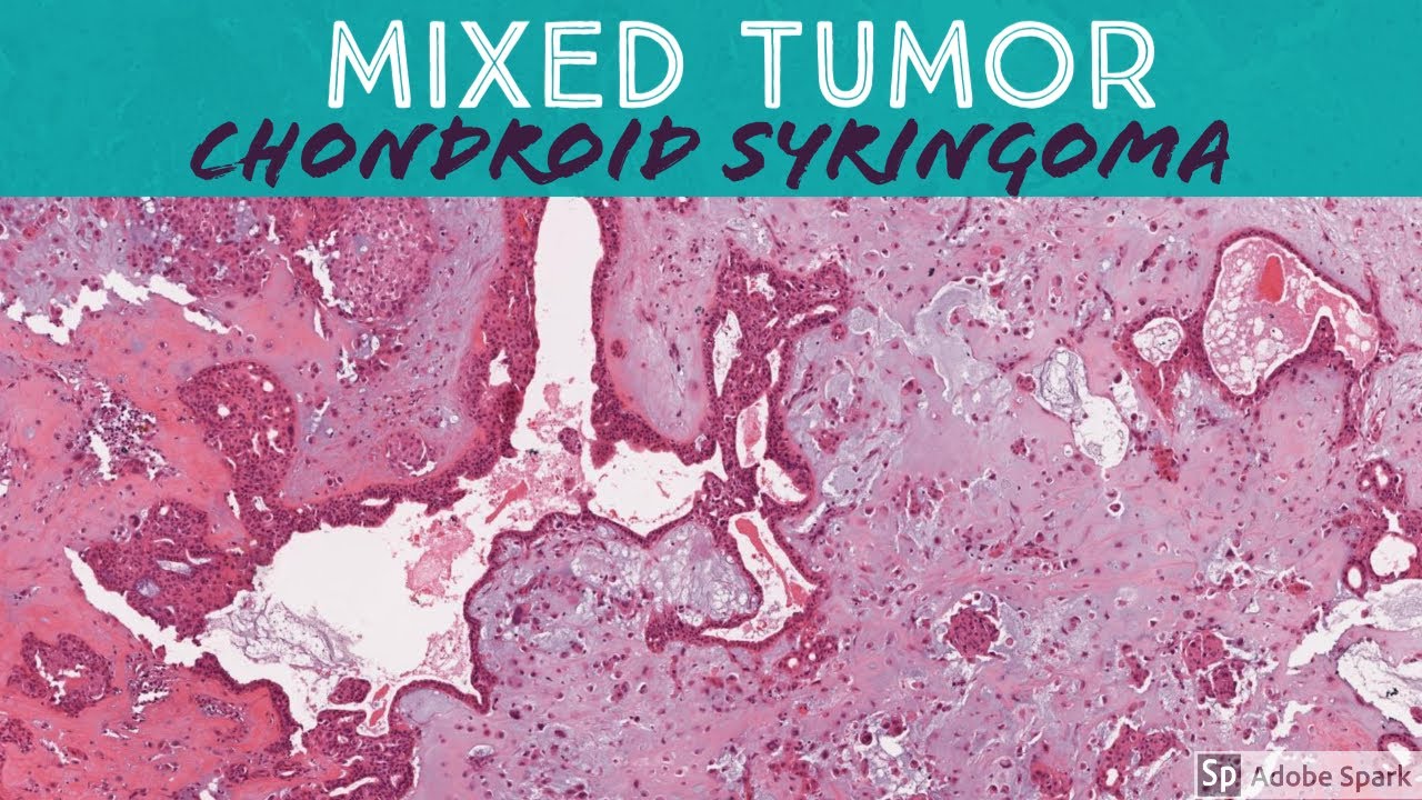 Chondroid Syringoma (Mixed Tumor): 5-Minute Pathology Pearls - YouTube