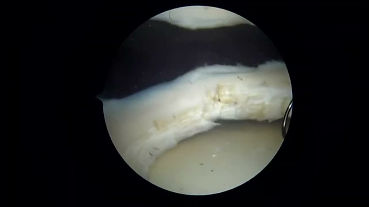 Meniscal resector - YouTube