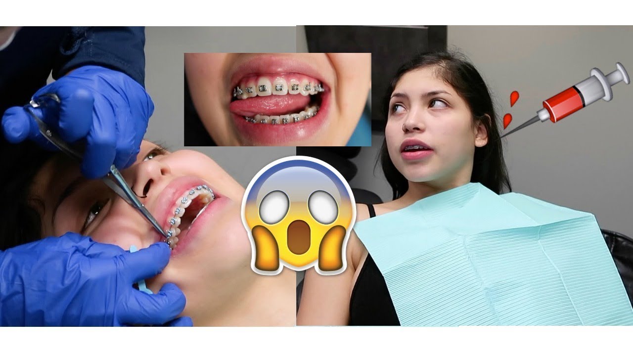ANOTHER LIT BRACES VLOG + BRACES UPDATE! - YouTube