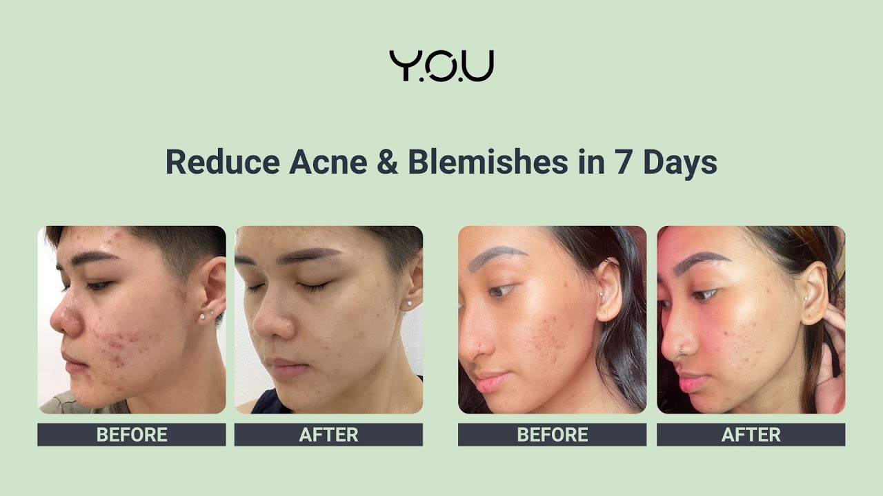 AcnePlus Series | Results in 7 Days | Bye Bye Acne & Blemishes - YouTube