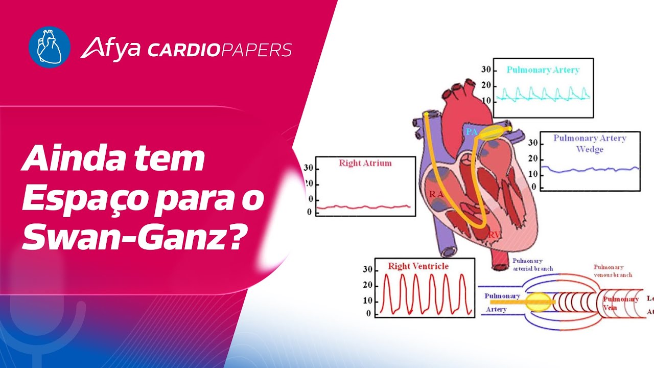 Cateter de artéria pulmonar (Swan‐Ganz) na monitorização hemodinâmica ...