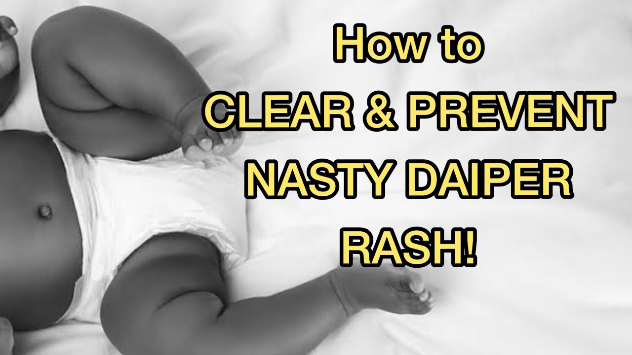 How to PREVENT and CLEAR NAPPY RASH. - YouTube