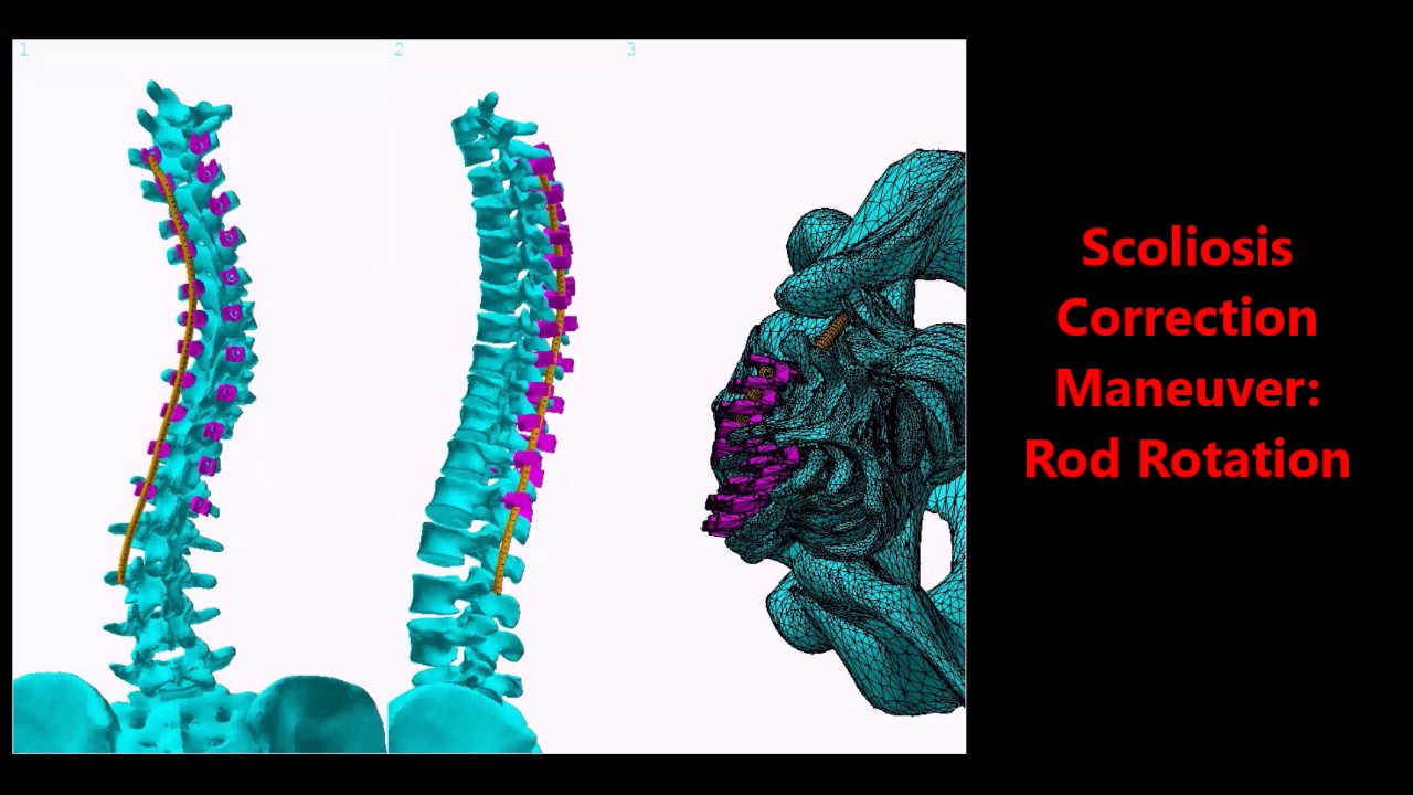 Spinologics Spinal Surgery Simulation (Ansys Hall of Fame Winner) - YouTube