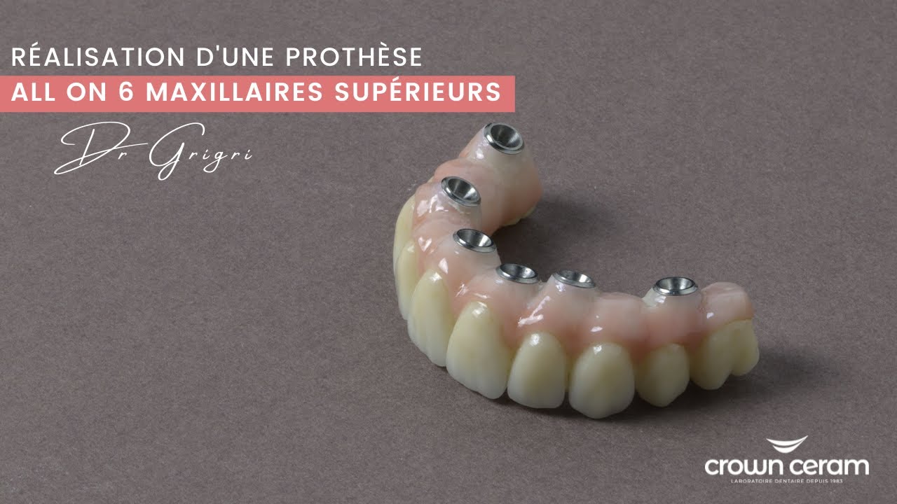 Réalisation d'une prothèse all on 6 maxillaires supérieurs - YouTube
