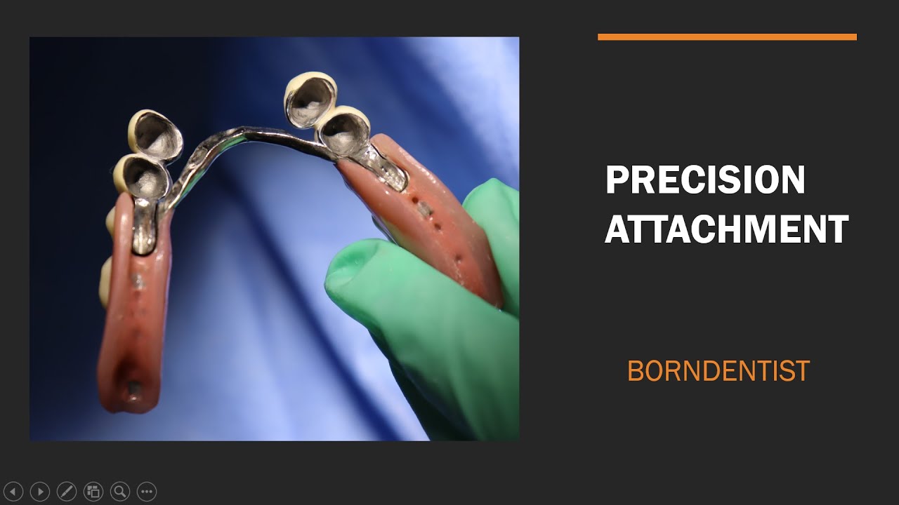 PRECISION ATTACHMENT IN RPD - YouTube