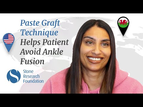 Unlocking Mobility: Natasha's Remarkable Ankle Restoration with the ...