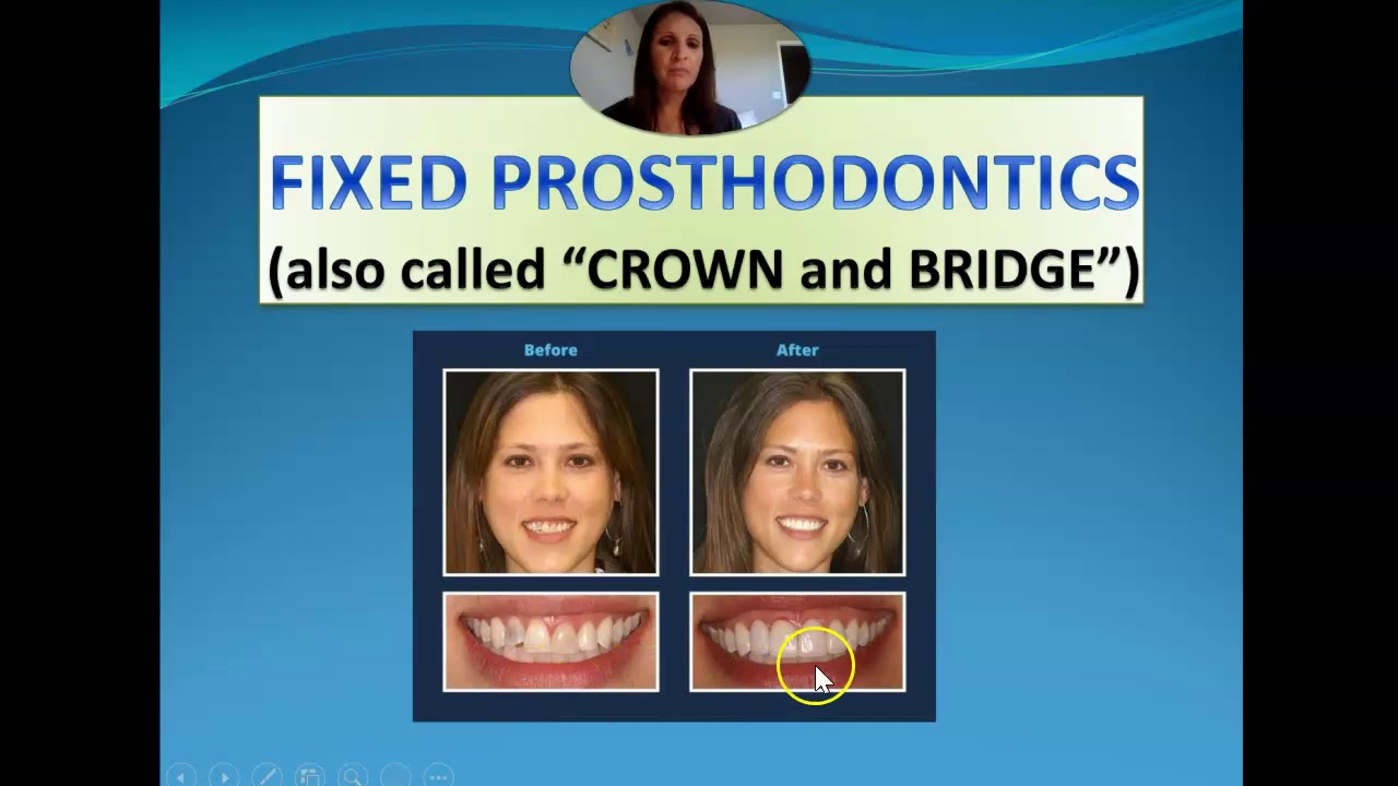 DEA 104-Fixed Prostho Intro - YouTube