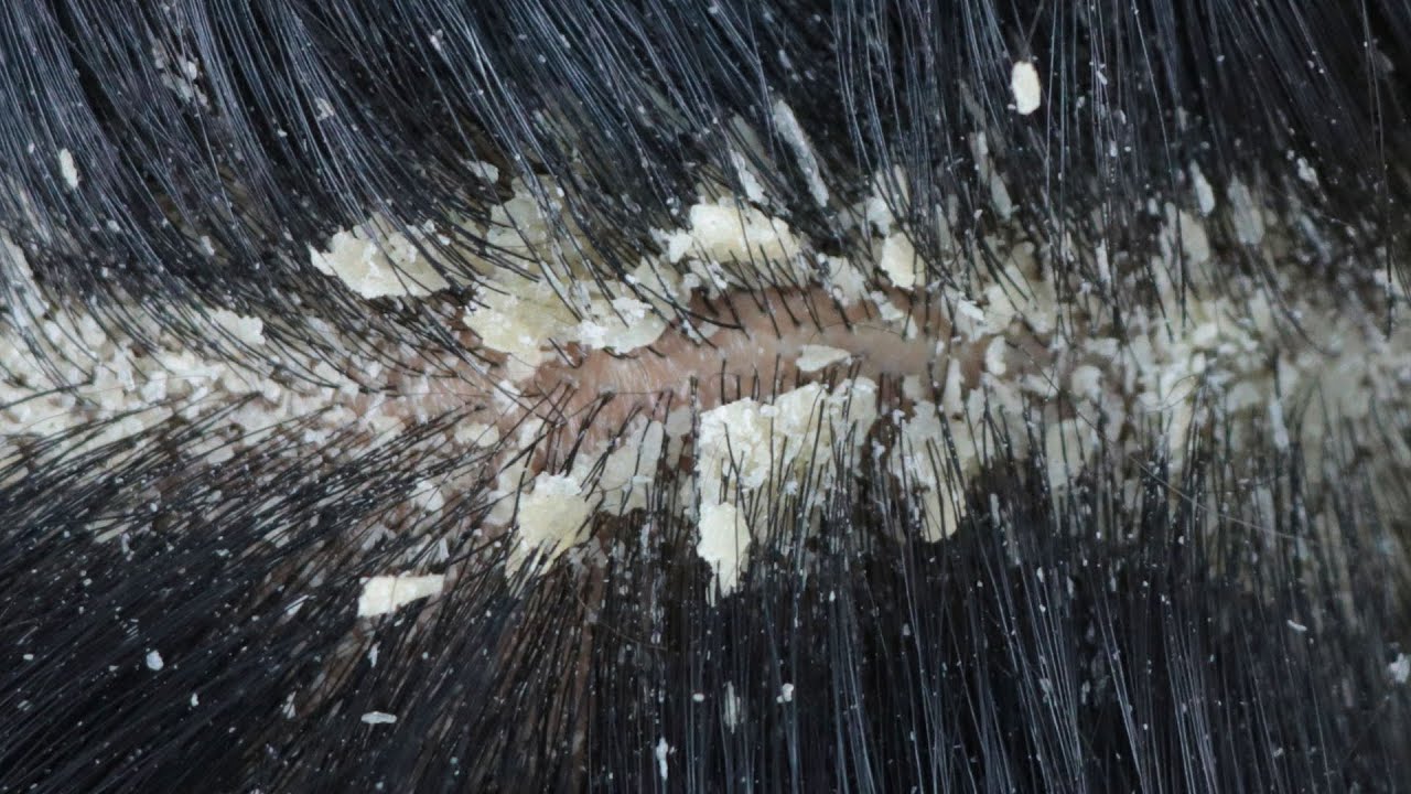 Dandruff Scratching Picking Combing Big Flakes HUGE SCALES - YouTube