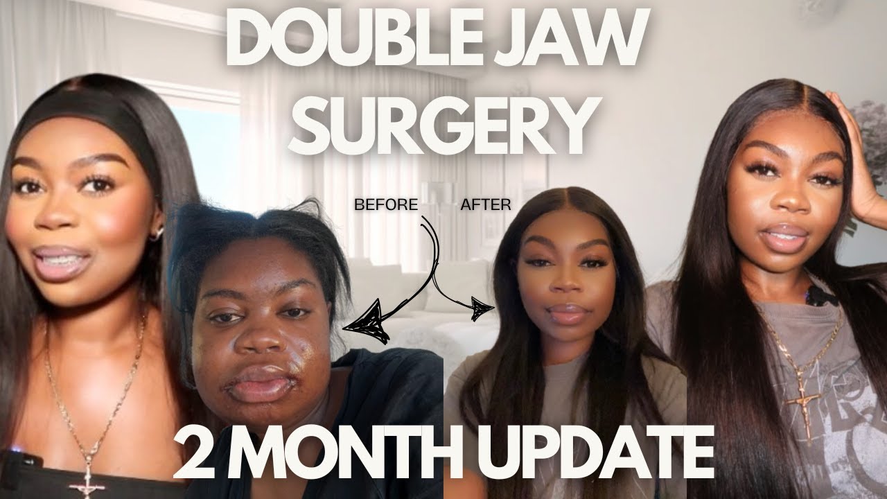 Double Jaw Surgery Update - Diet, Confidence, Swelling | 2 MONTH UPDATE ...