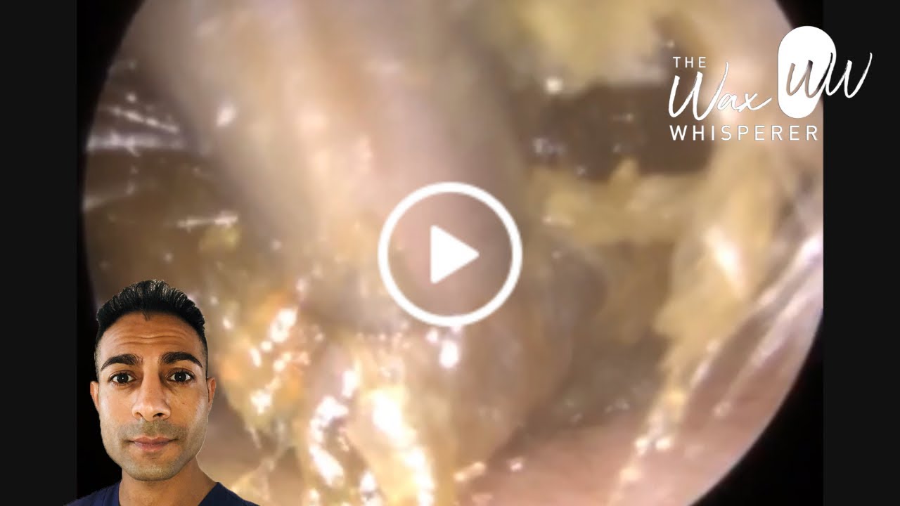 978 - Fully Blocked Ear Wax & Dead Skin Peel Extraction - YouTube
