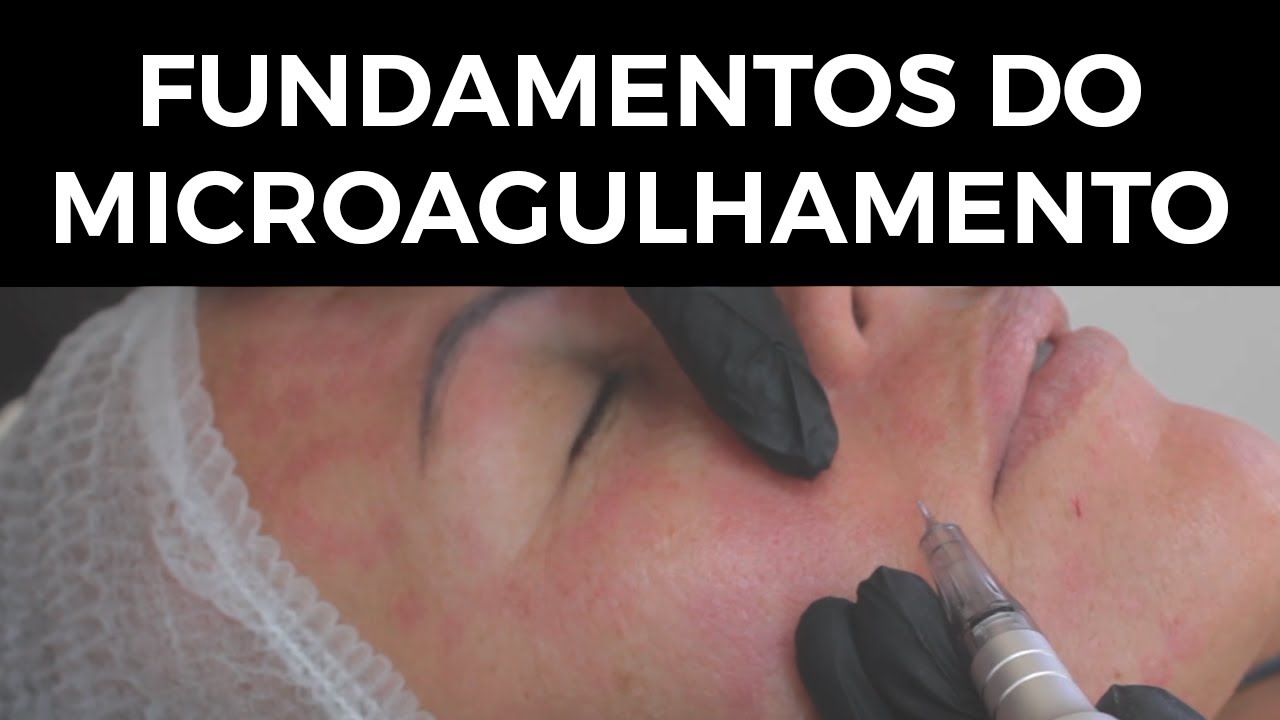 FUNDAMENTOS DO MICROAGULHAMENTO - YouTube