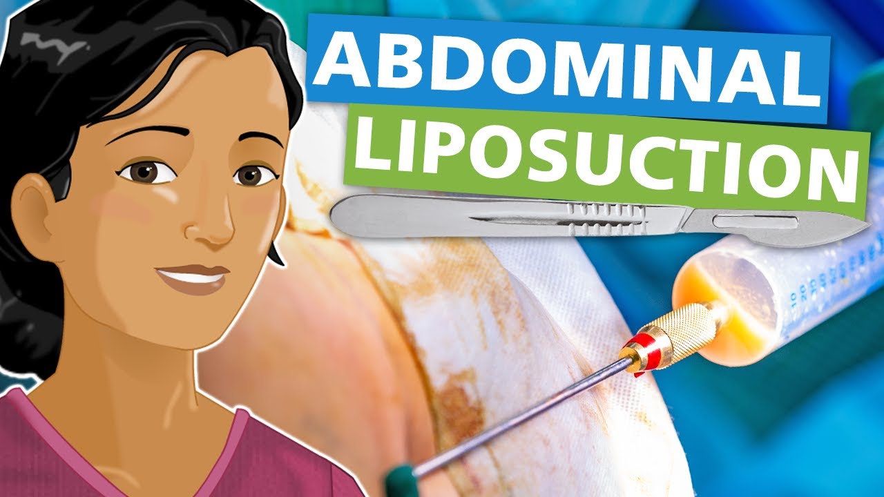 Tumescent Liposuction - YouTube