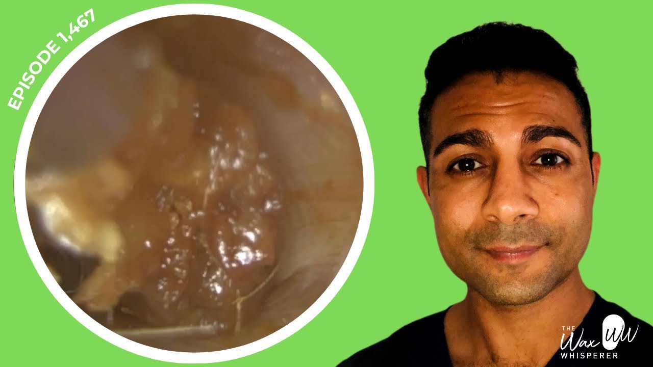 1,467 - Difficult Removal of Ear Wax From Collapsed Ear Canal in ...