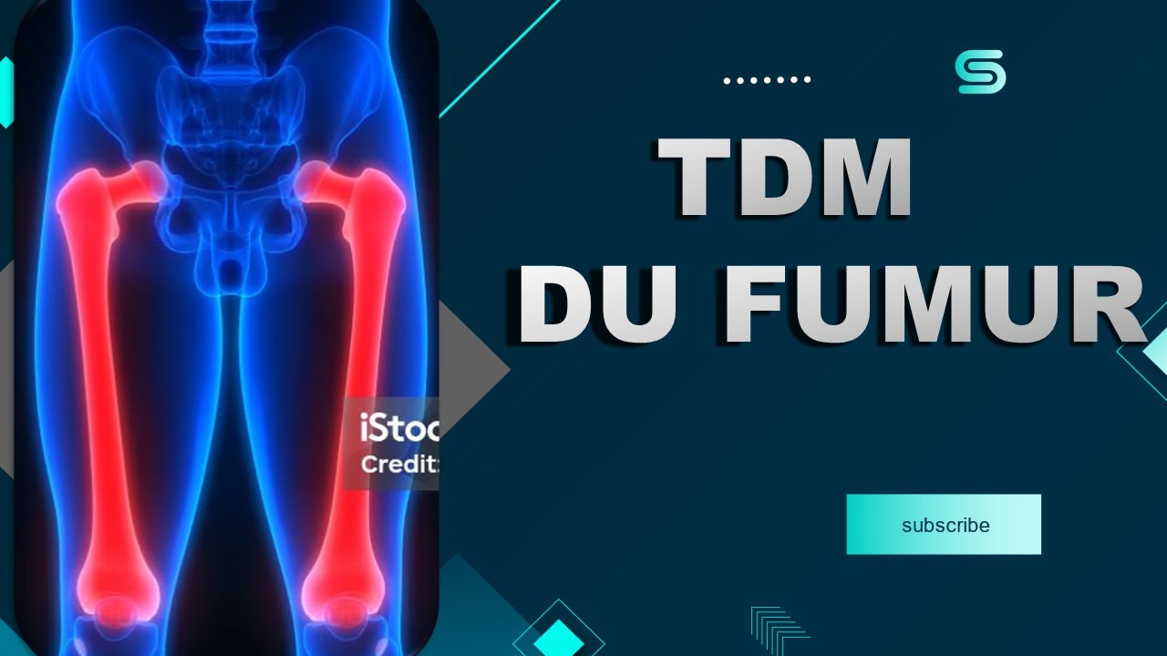 Bonne Pratique en Scanner : TDM DU FEMUR SPC - YouTube