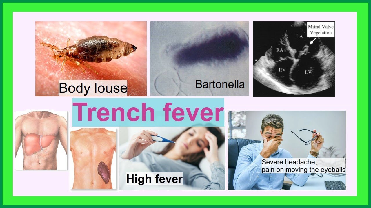 trench fever - YouTube