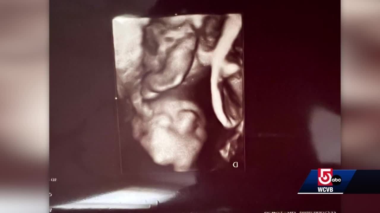 Quadruplet Ultrasound One In 40 Million Odds: Couple Welcomes