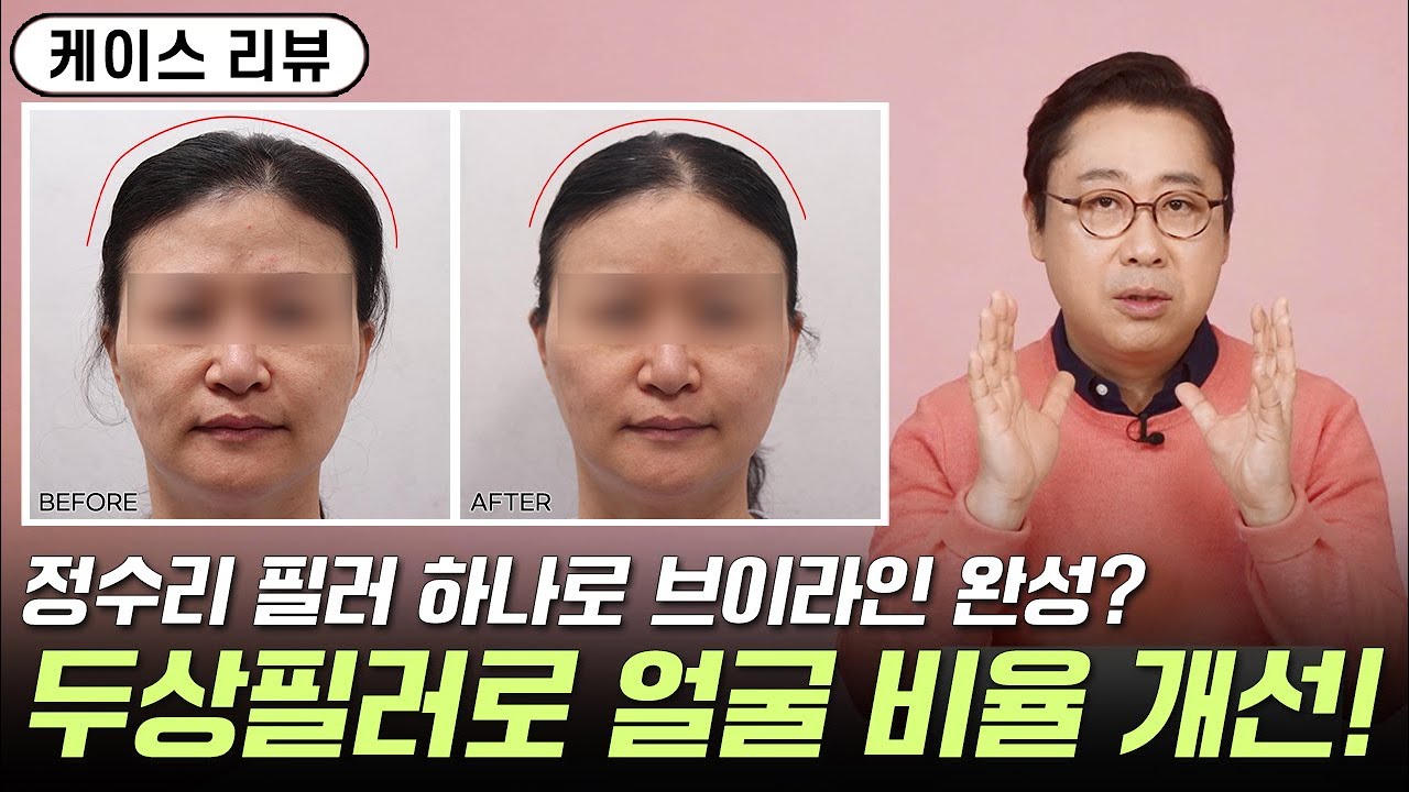 계란형 얼굴 만드는 정수리 두상 필러 케이스 리뷰 Youtube