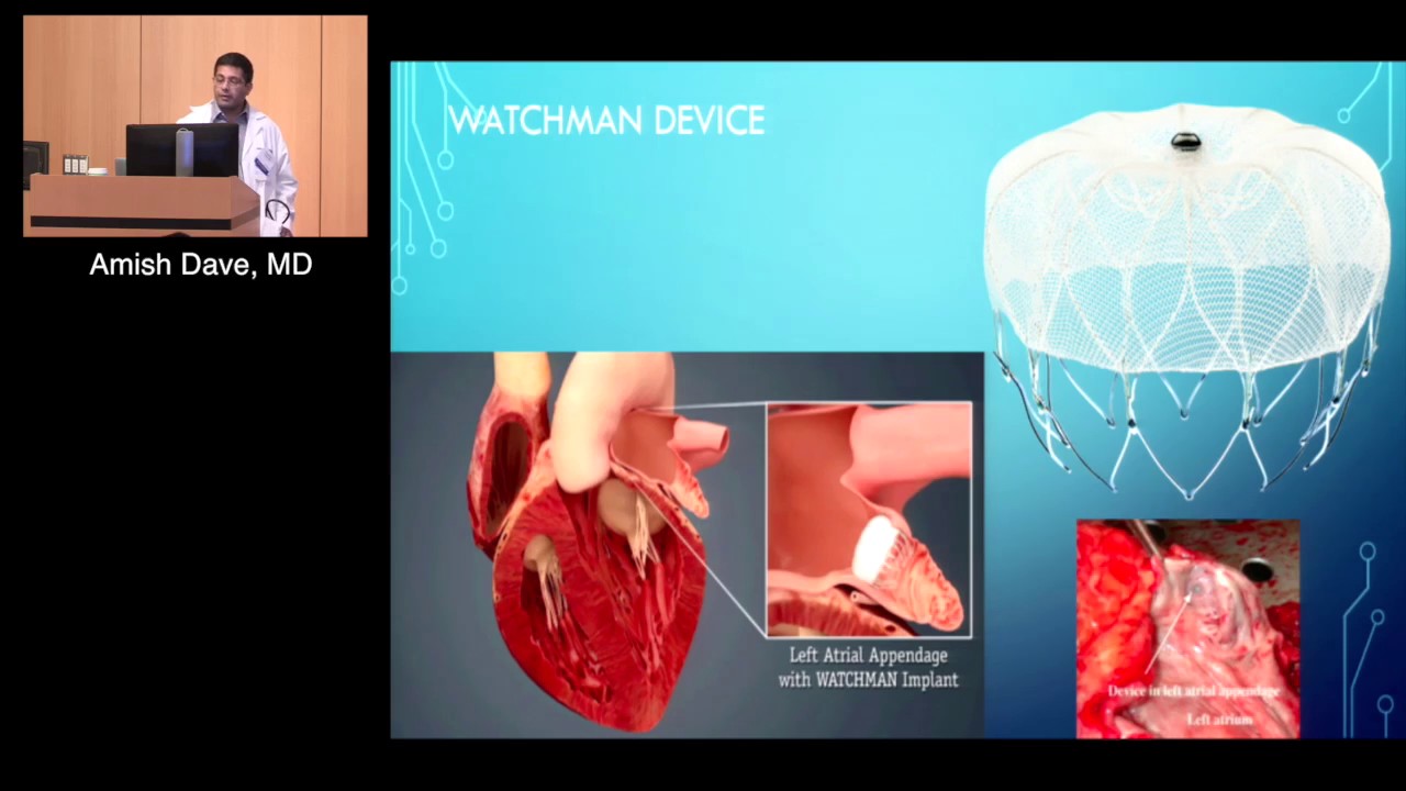 Optimizing Heart Failure with Electrophysiology Interventions (Amish ...