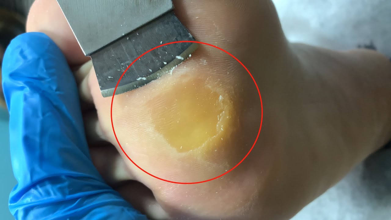 The calluses in the center of the soles are yellow and thick!【Xiao Yan ...