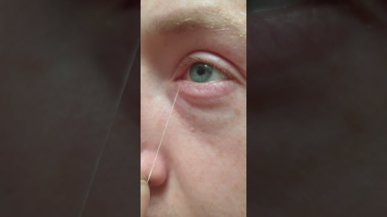 WHAT IS THAT IN HIS EYE?! - one of the first big ones - MORE ON OUR ...