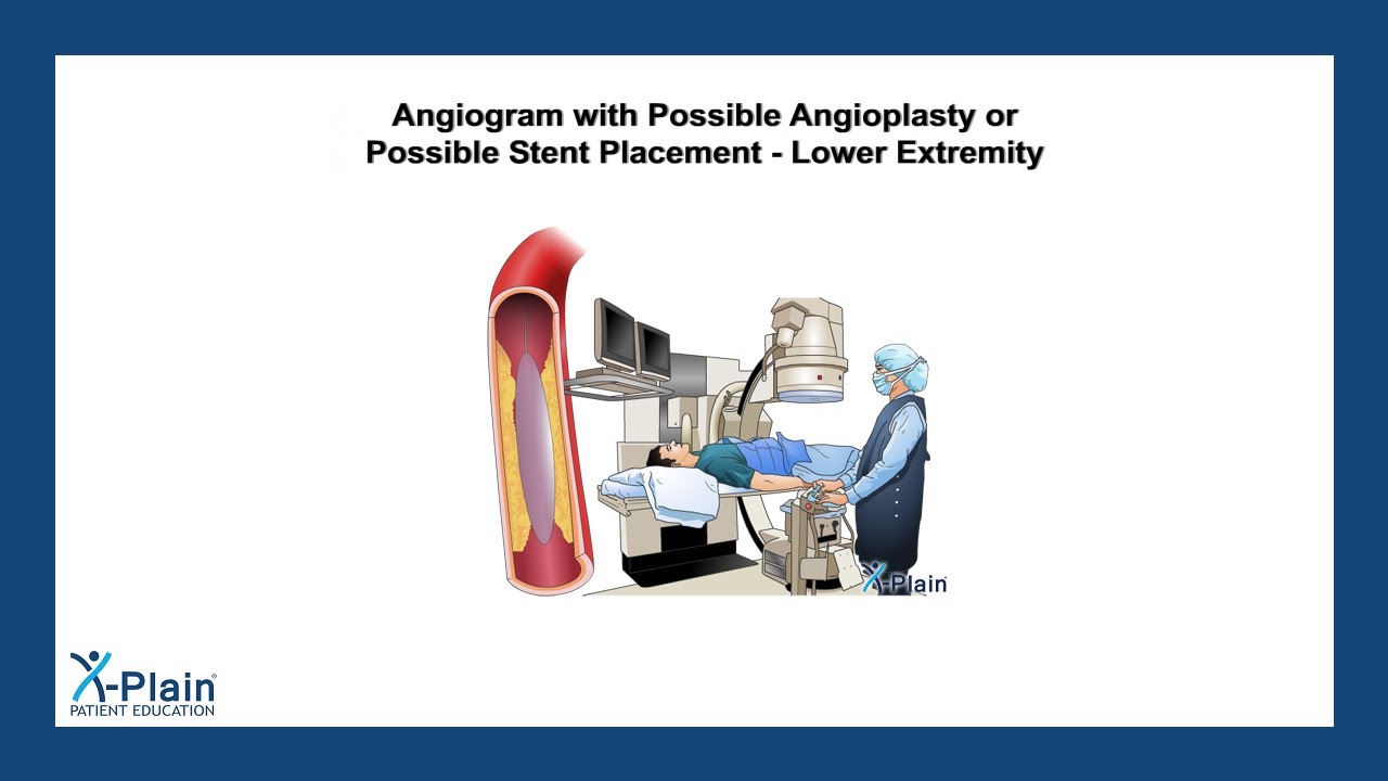 Angiogram with Possible Angioplasty or Possible Stent Placement - Lower ...
