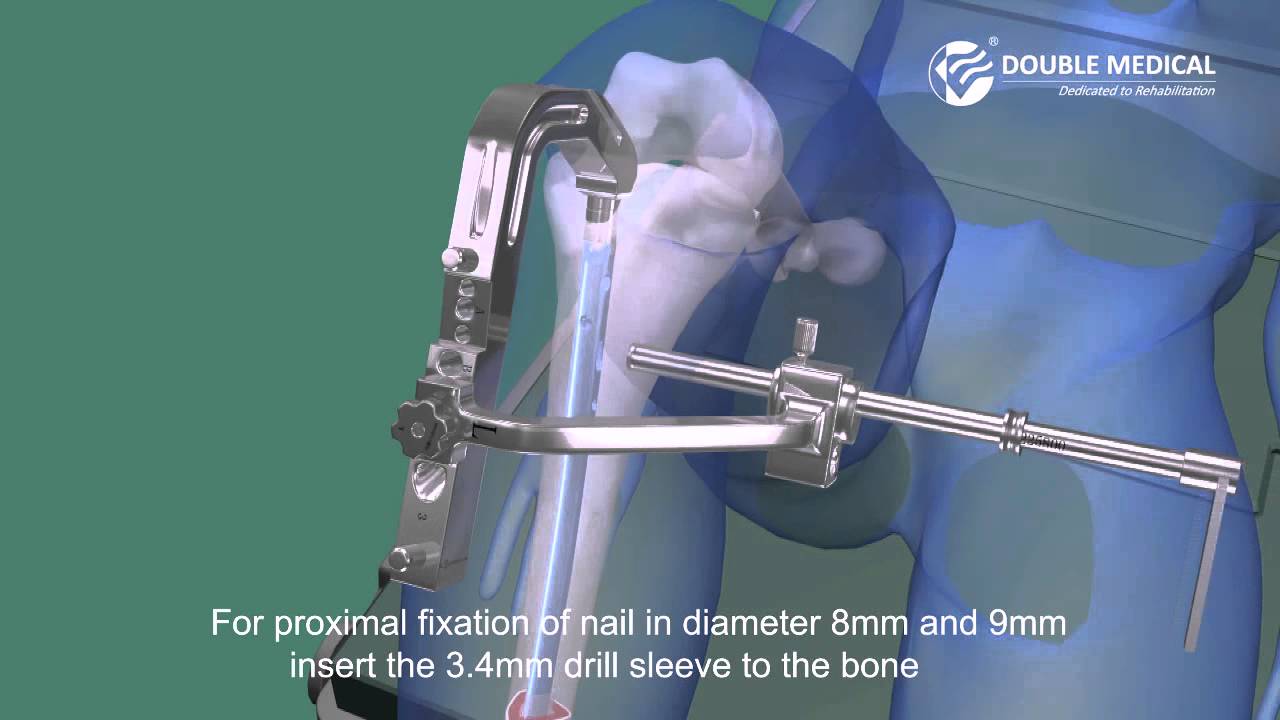 Universal Tibial Nail II - YouTube