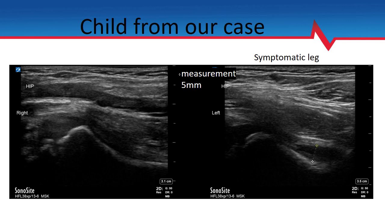 Hips Don't Lie: Hip Ultrasound in the Evaluation of the Limping Child ...